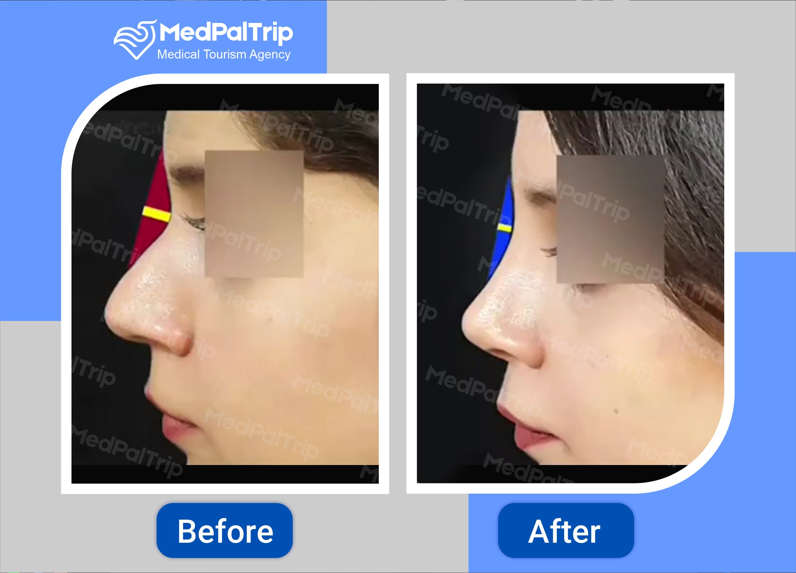 Rhinoplasty in Iran Before and After Photos | MedPalTrip