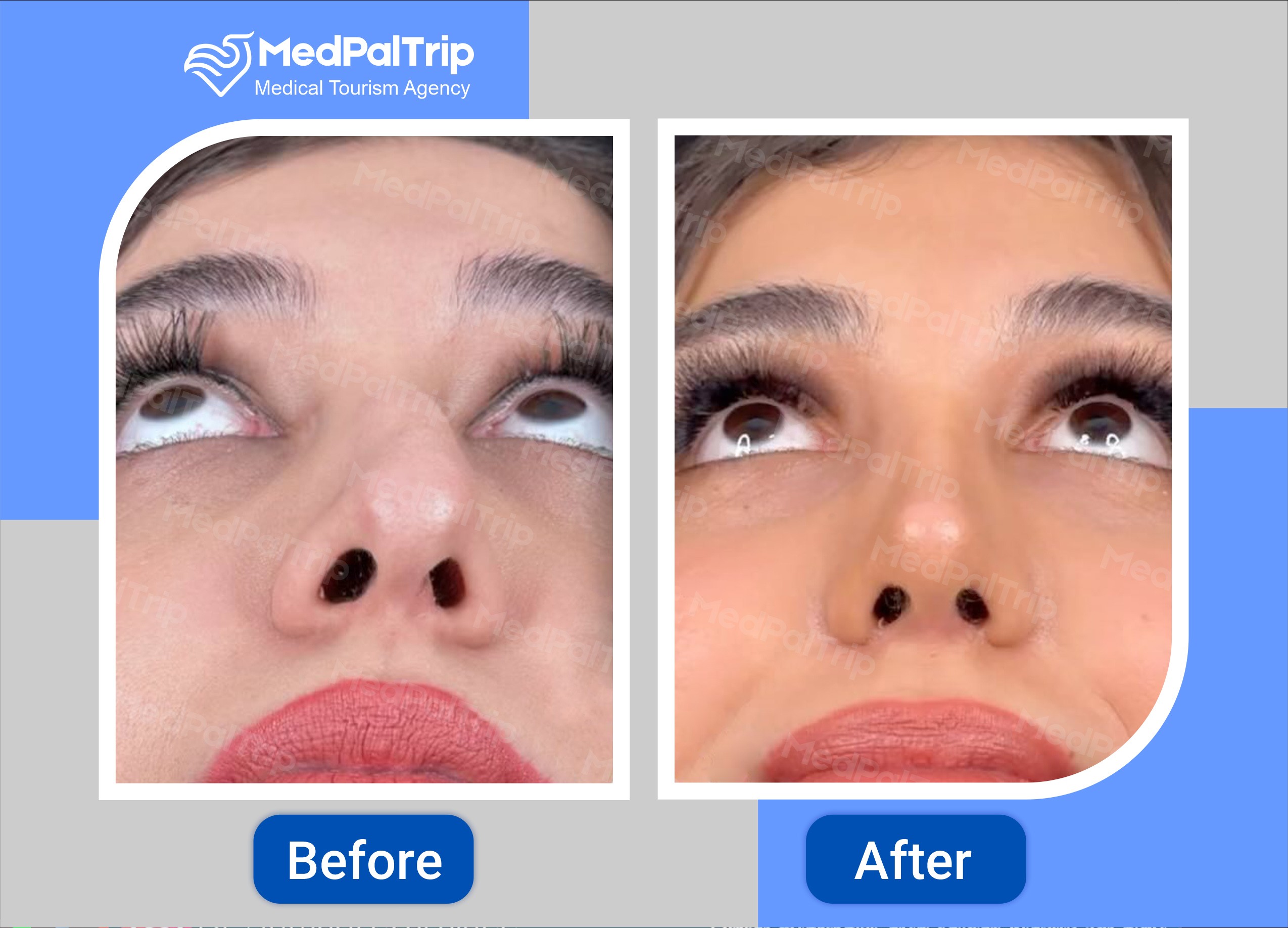 Rhinoplasty in Iran Before and After Photos | MedPalTrip