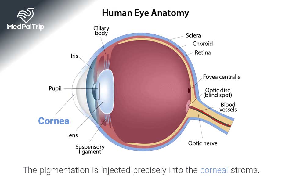 What is Keratopigmentation: Miracle or Mistake? | MedPalTrip