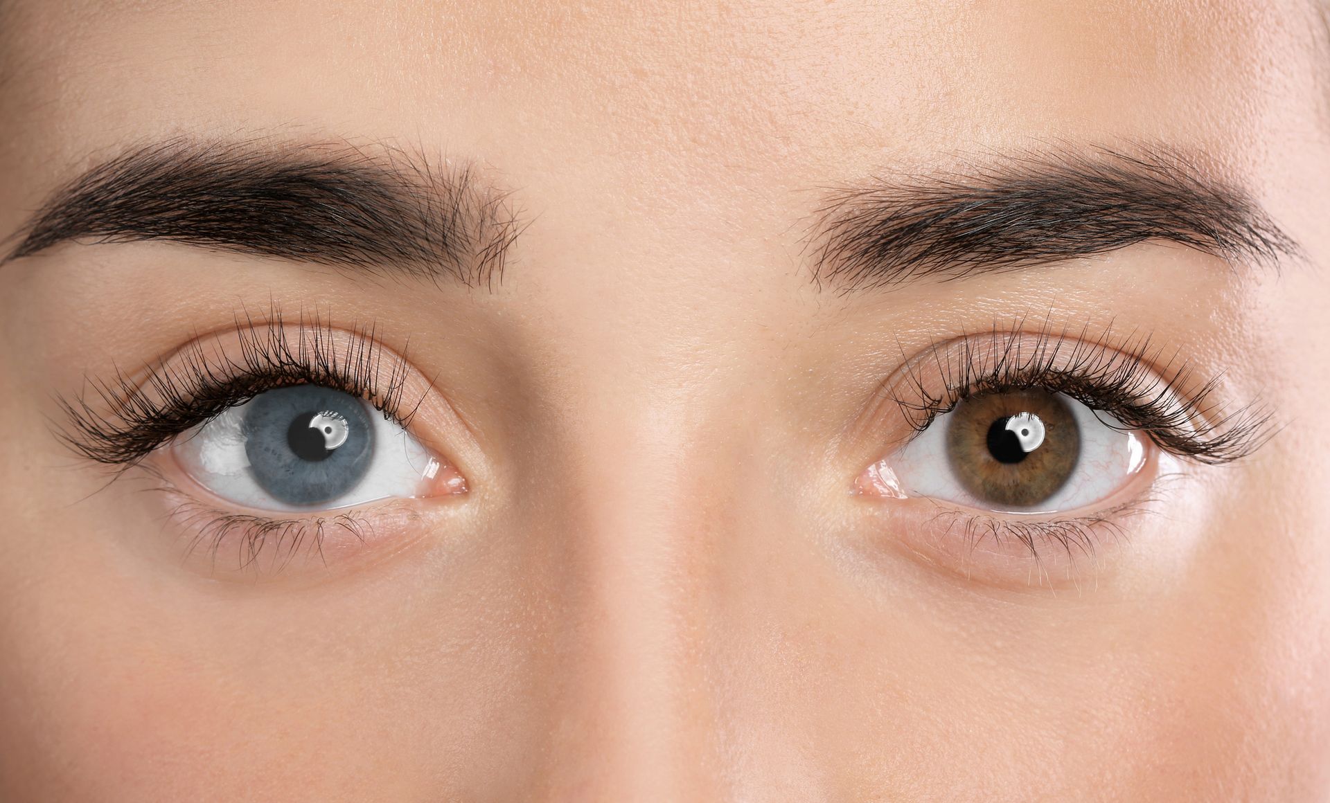 What Happens Before & After Eye Color Surgery? Here’s What to Expect ...